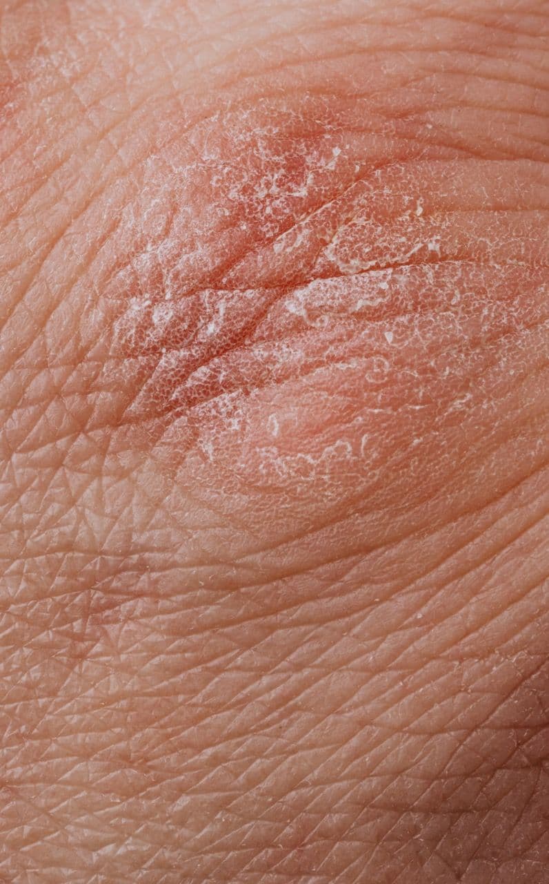 PNDS de la dermatomyosite