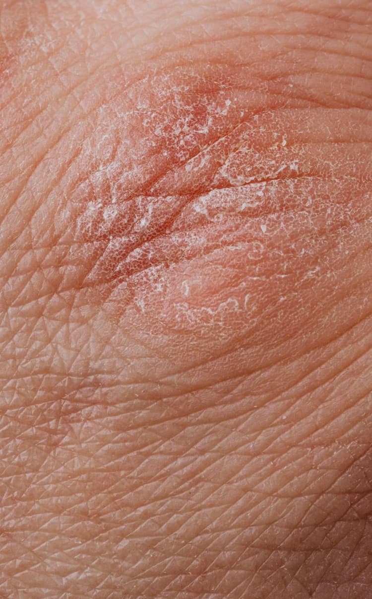 La papule en dermatologie